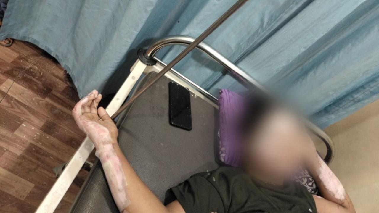 Mumbai: Jilted lovers threw acid-like boiling fluid on woman and her paramour